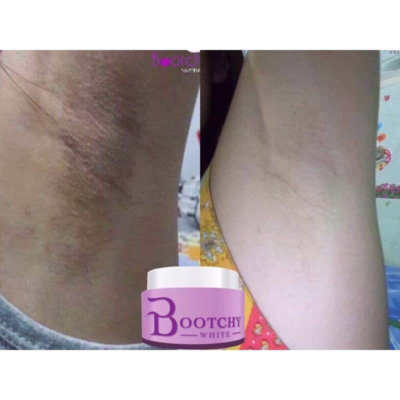 ส่งฟรีครีมลดรอยแตกลาย BootchyWhite บูชชี่ไวท์ บูชชี่ไวท์ของแท้ ระงับกลิ่นกาย รักแร้ขาว คอดำ ขา ...