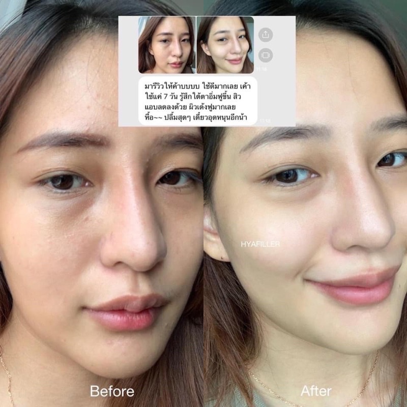 ส่งฟรี มีปลายทาง HAEWON HYA Filler เซรั่มไฮยาลูรอนเข้มข้น 15ml ไฮยา ฟิล ...