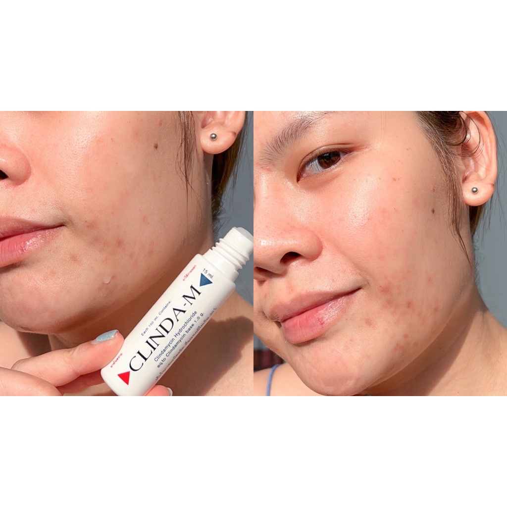 พร้อมส่งล๊อตใหม่มาก คลินดาเอ็ม (Clinda M) ครีมแต้มสิว สิวอักเสบ สิวหัว ...