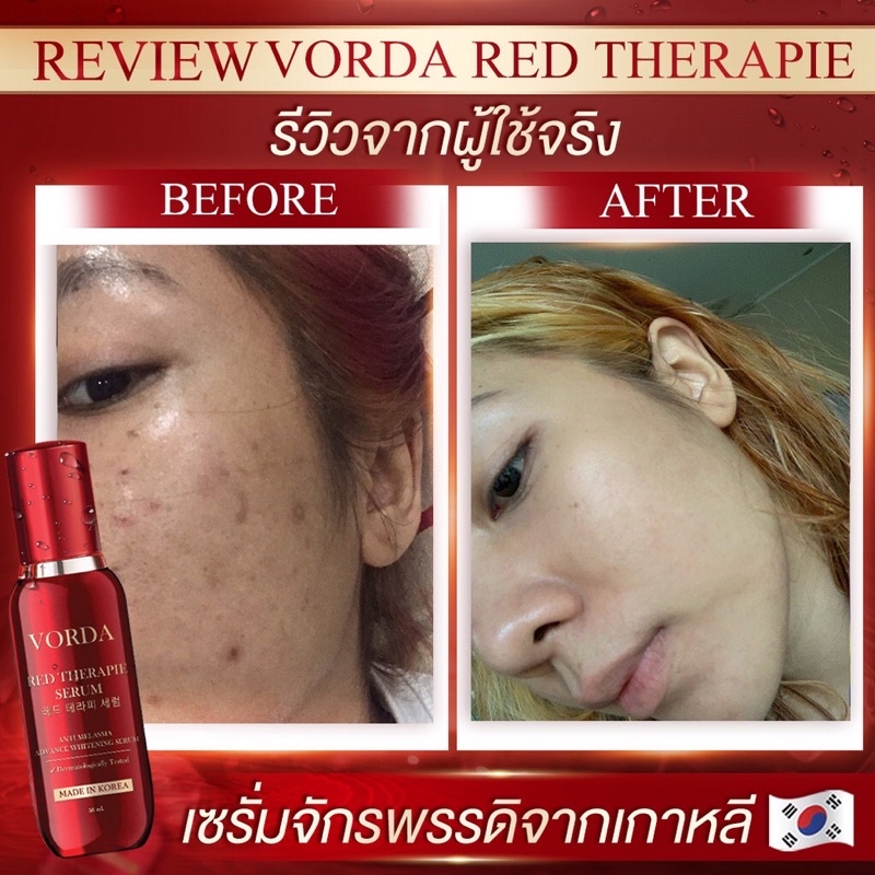3แถม 2 เซรั่มฝ้า วอร์ด้า ดิวอริสา แท้ Vorda Red Therapie Serum เซรั่มจักรพรรดิ ลดฝ้า กระ จุดด่าง ...
