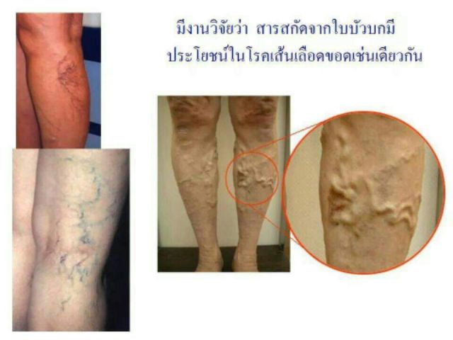 กิฟฟารีน โกตูล่า ซีอี ใบบัวบกสกัด แก้ริดสีดวง เส้นเลือดขอด ลดเบาหวาน ...
