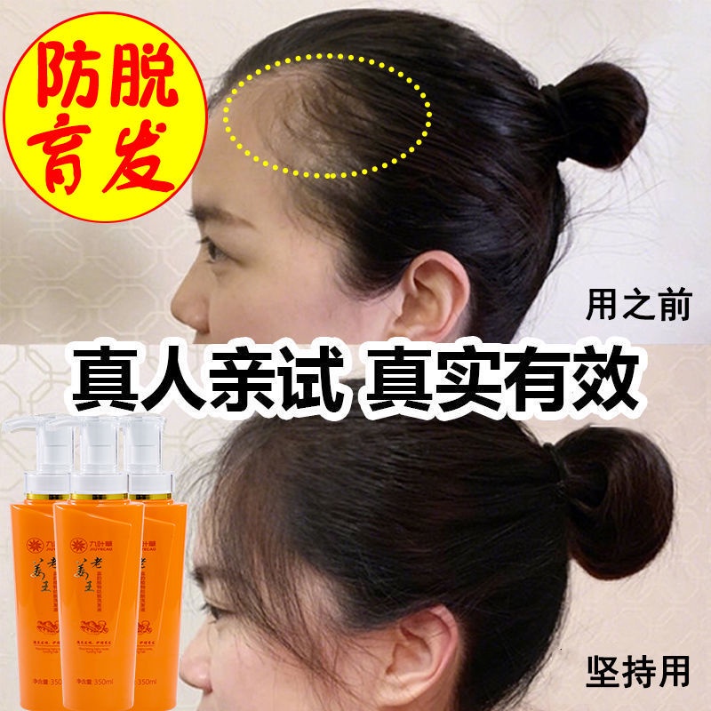 ป้องกันผมร่วง ปลูกผม ผู้ชายและผู้หญิง for ↂแชมพูขิงแก่ขิงแท้จาก Nine ...