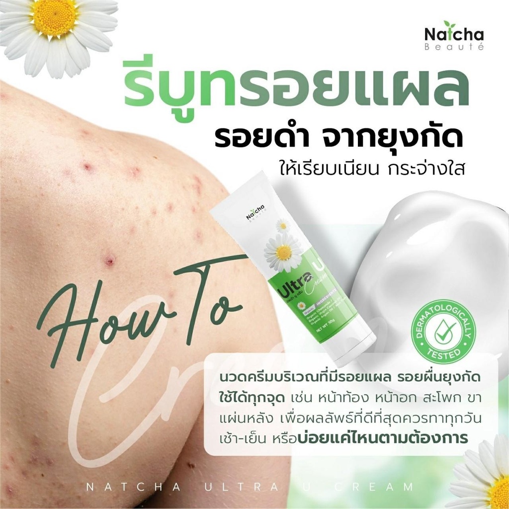 ครีมทาผิวหนังอักเสบ เชื้อรา สะเก็ดเงิน ครีมสำหรับใช้ภายนอก ครีมอัลตร้ายู Ultra U 1 หลอด 30 กรัม ...