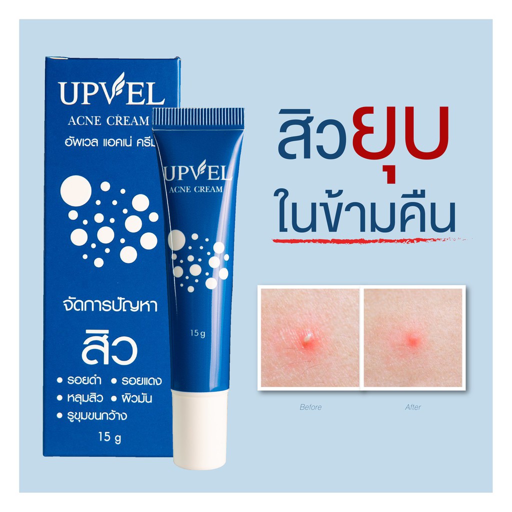 UPVEL Melasma Cream / Acne Cream เมลาสม่า ครีมทาฝ้า // แอคเน่ ครีมแต้ม ...