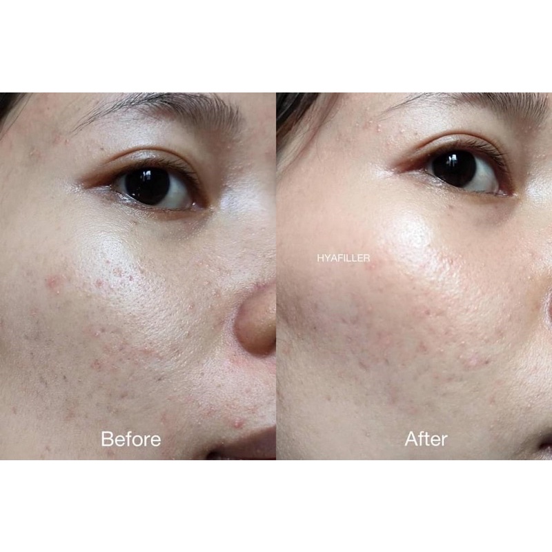 ส่งฟรี มีปลายทาง HAEWON HYA Filler เซรั่มไฮยาลูรอนเข้มข้น 15ml ไฮยา ฟิล ...