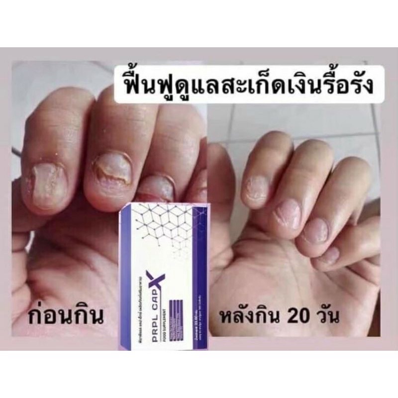 ถูกที่สุดส่งฟรีPRPL CAPXเพอเพิลแคปเอ็กซ์ อาหารเสริมฟื้นฟูเซลล์ ️ของแท้ ...