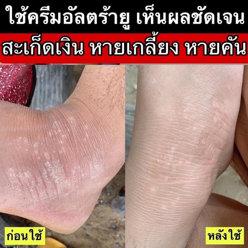 อัลตร้ายูครีม เซ็ท 3 หลอด ของแท้ ส่งฟรี Natcha Ultra U Cream - phaniddashop - ThaiPick
