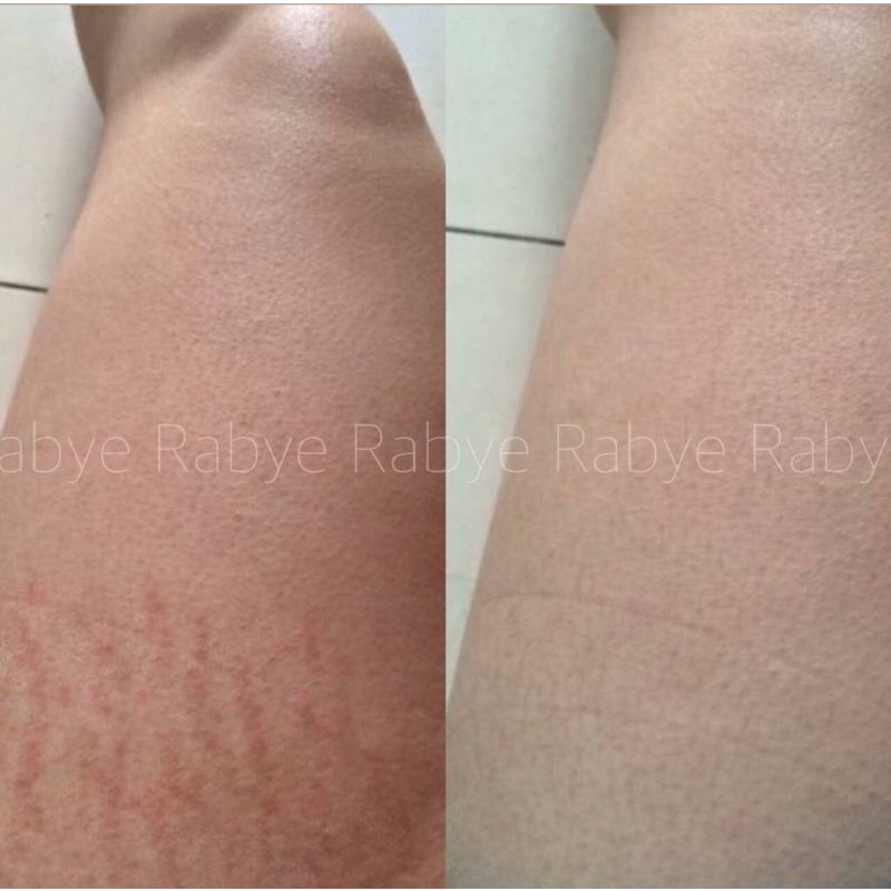 Rabye Happy Set จัดการปัญหาขนคุด รอยดำ ผิวแตกลาย เห็นผลคุ้มค่า 100 ...