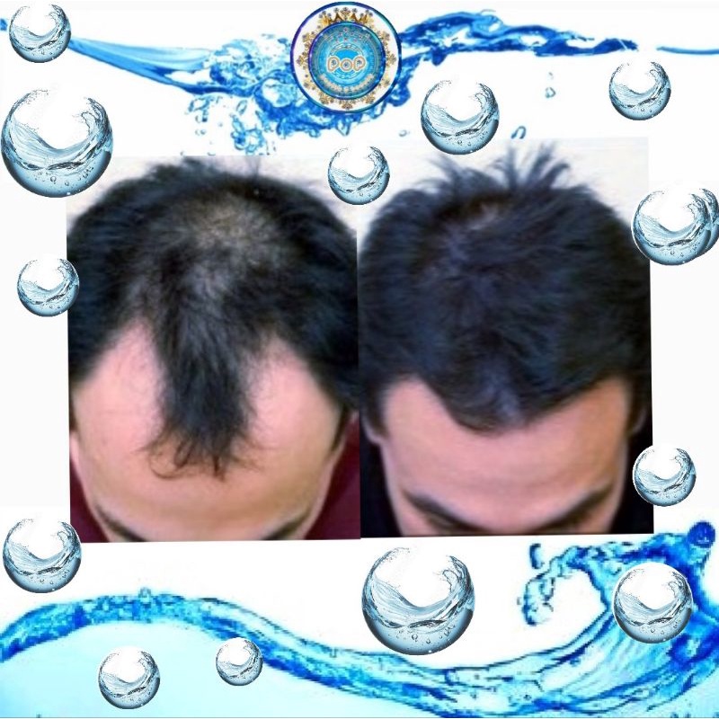 Finasteride1mg harifinแฮริฟิน 1 mg. 1 กล่อง 30 เม็ด - popup99 - ThaiPick