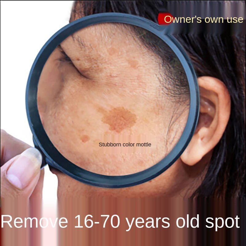 Powerful Whitening and Freckle Removing Cream Product Chloasma Senile ...