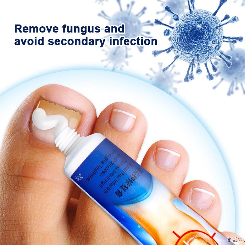 5 10pcs Nail Fungal Treatment Cream Paronychia Onychomycosis Care ...
