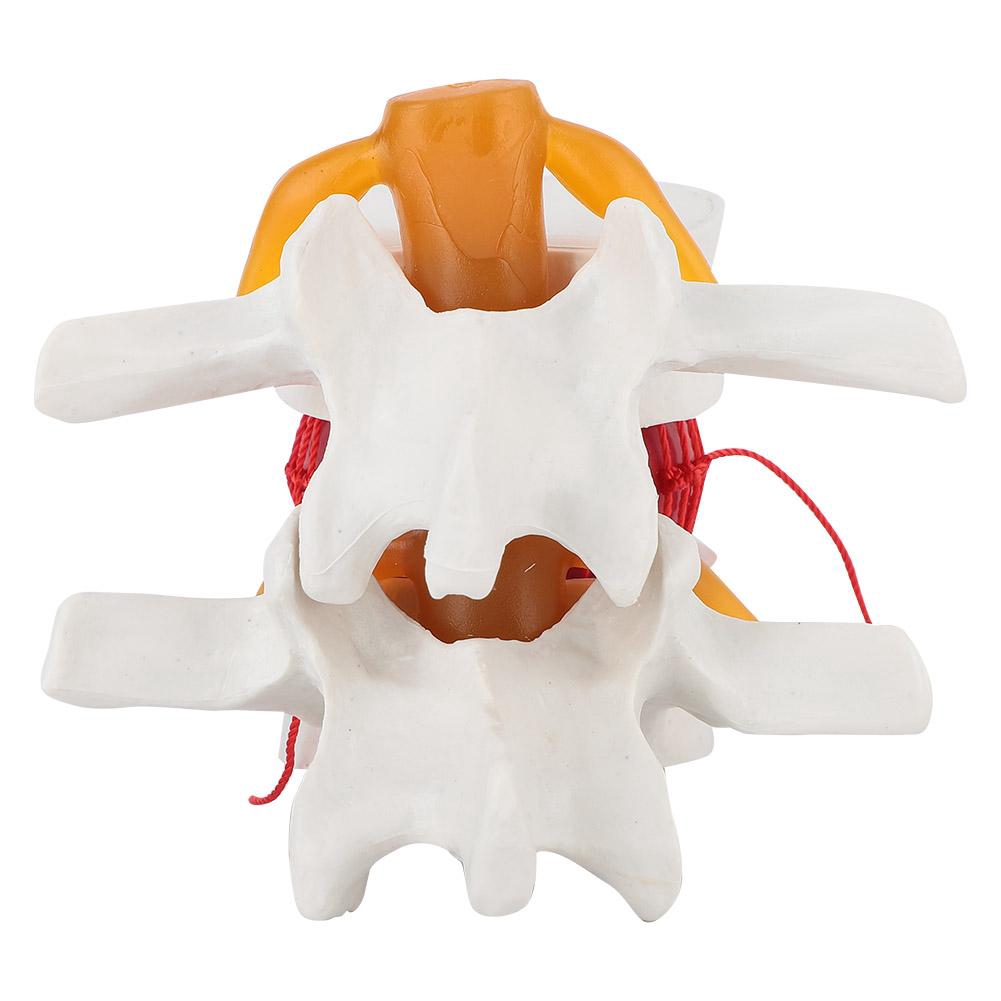Human 1 Model Herniation Lumbar 1 Medical Disc 5 Of Spine Vertebral ...