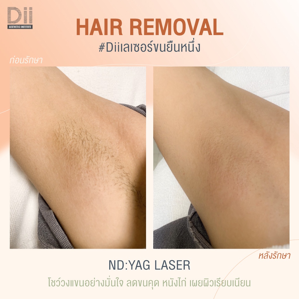 Dii Aesthetic : Hair removal Under Arm 1Time - dii_aesthetic - ThaiPick