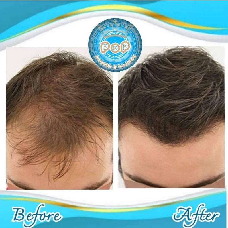 pip Minox 5 เร่งรากผมให้หนา ดกดำ 100เม็ด - poprock789 - ThaiPick