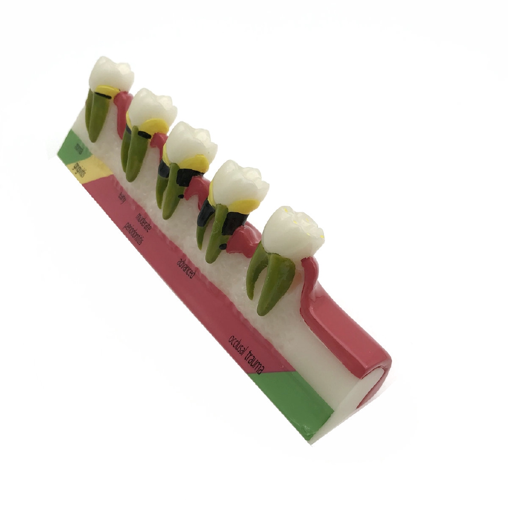 Dental Teeth Model Periodontal Disease Assort Tooth Classification ...