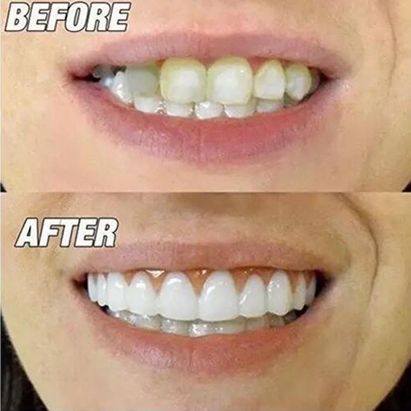 2PC Professional Perfect Smile Veneers Dub Stock Correction Teeth ...