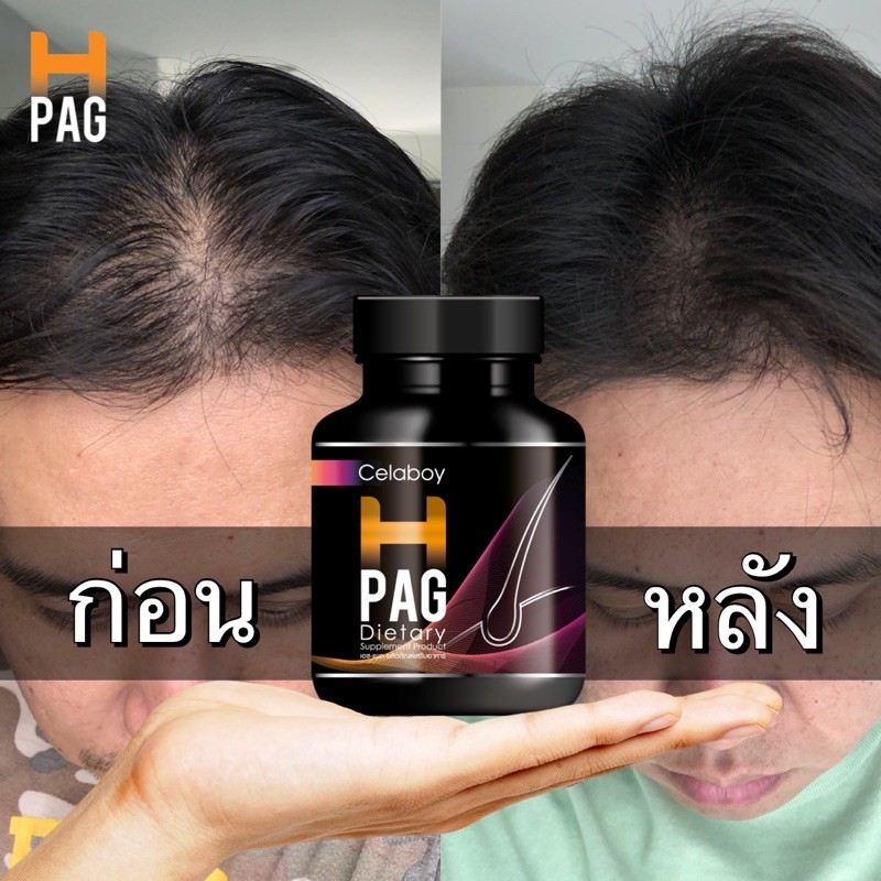 HPAG วิตามินเส้นผม ปลูกผม ผมร่วง (30แคปซูล) - king_waffle_official ...