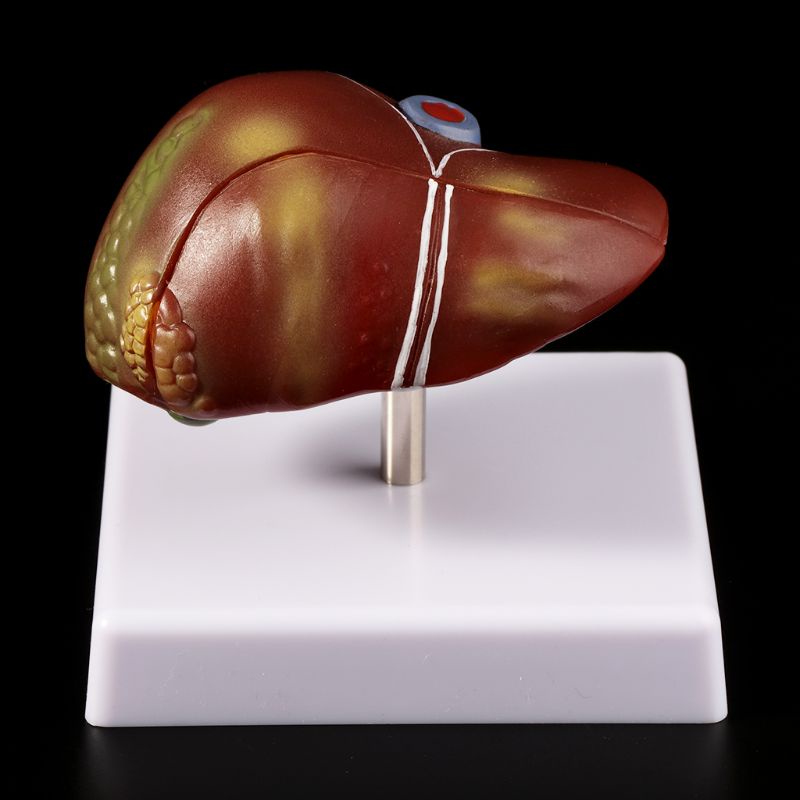 GOO Human Liver Pathological Anatomical Model Anatomy School Medical ...