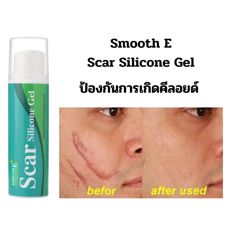 Smooth E เจลทาแผลเป็นช่วยให้แผลนุ่ม แผลเป็นเรียบเนียน Scar Silicone Gel ...