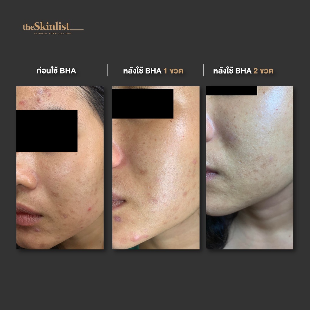 The Skinlist BHA Acne Intense Care SerumPrebiotic - theskinlist ...