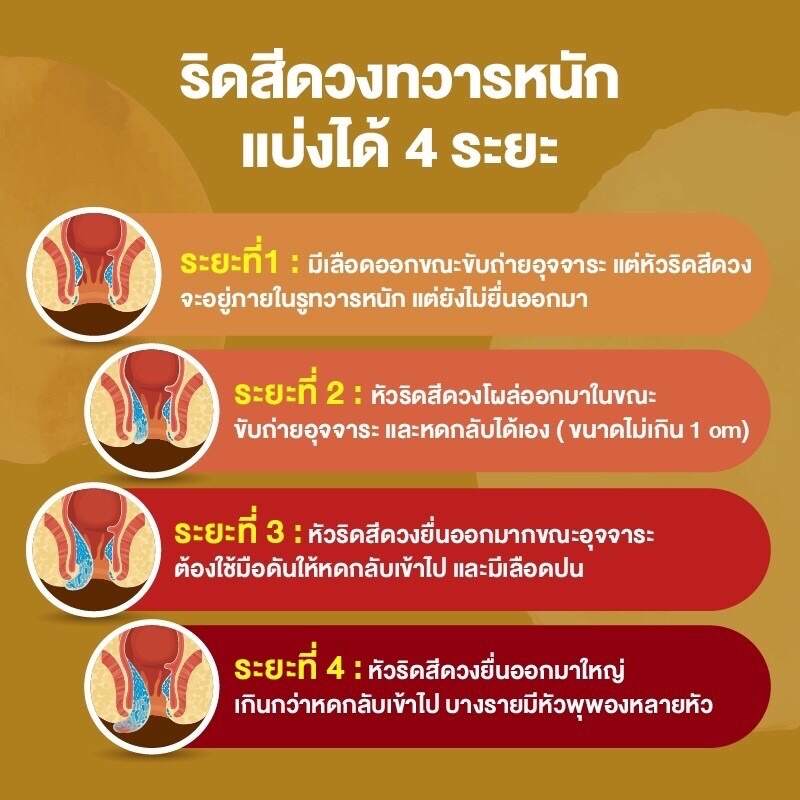 SAND - M LEON ลีออน ริดสีดวงทวาร ( 1 กล่อง 30 แคปซูล ) ไม่ปวดอักเสบ ...