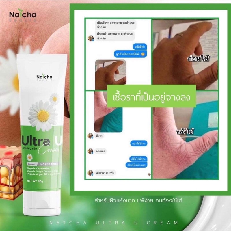 อัลตร้ายูครีม เซ็ท 6 หลอด แถมฟรี สบู่แก้เชื้อรา 1 ก้อน ของแท้ ส่งฟรี Natcha Ultra U Cream ...