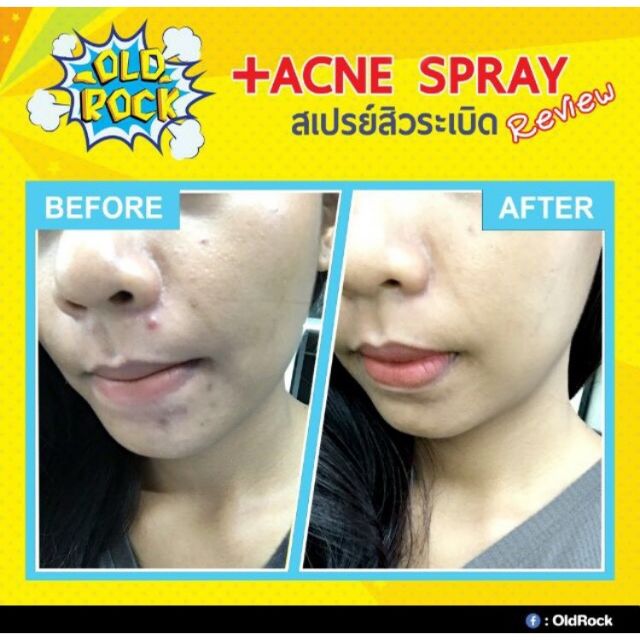 สเปรย์สิวที่หน้า ค่าส่งถูก Old Rock Acne Spray 15 ml. ราคาเบาๆ สเปร์ย ...