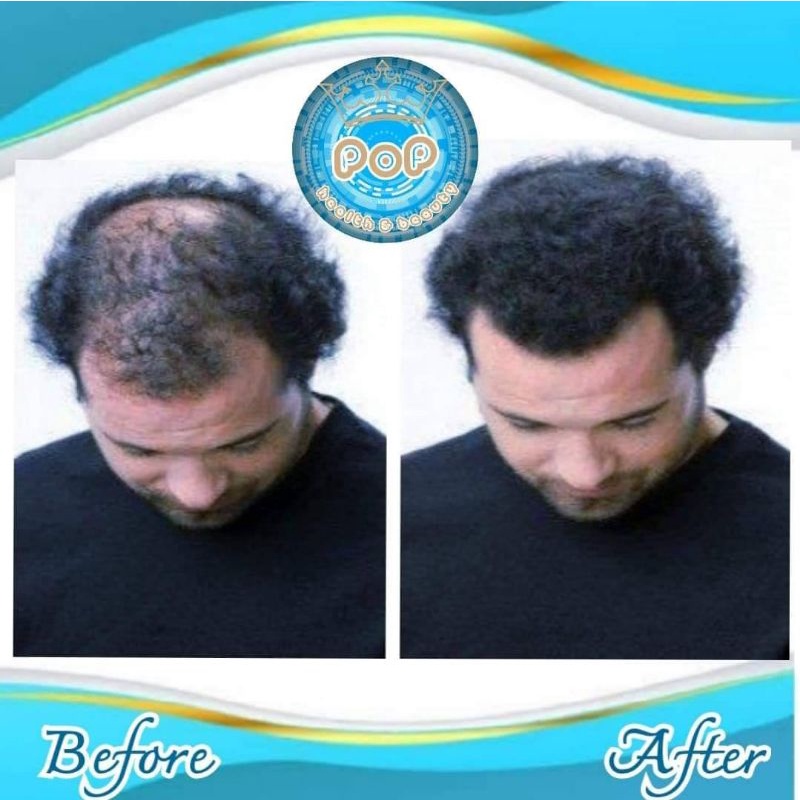 pip Minox 5 เร่งรากผมให้หนา ดกดำ 100เม็ด - poprock789 - ThaiPick