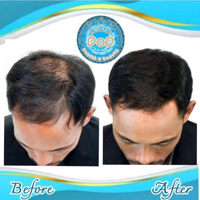 pip Minox 5 เร่งรากผมให้หนา ดกดำ 100เม็ด - poprock789 - ThaiPick