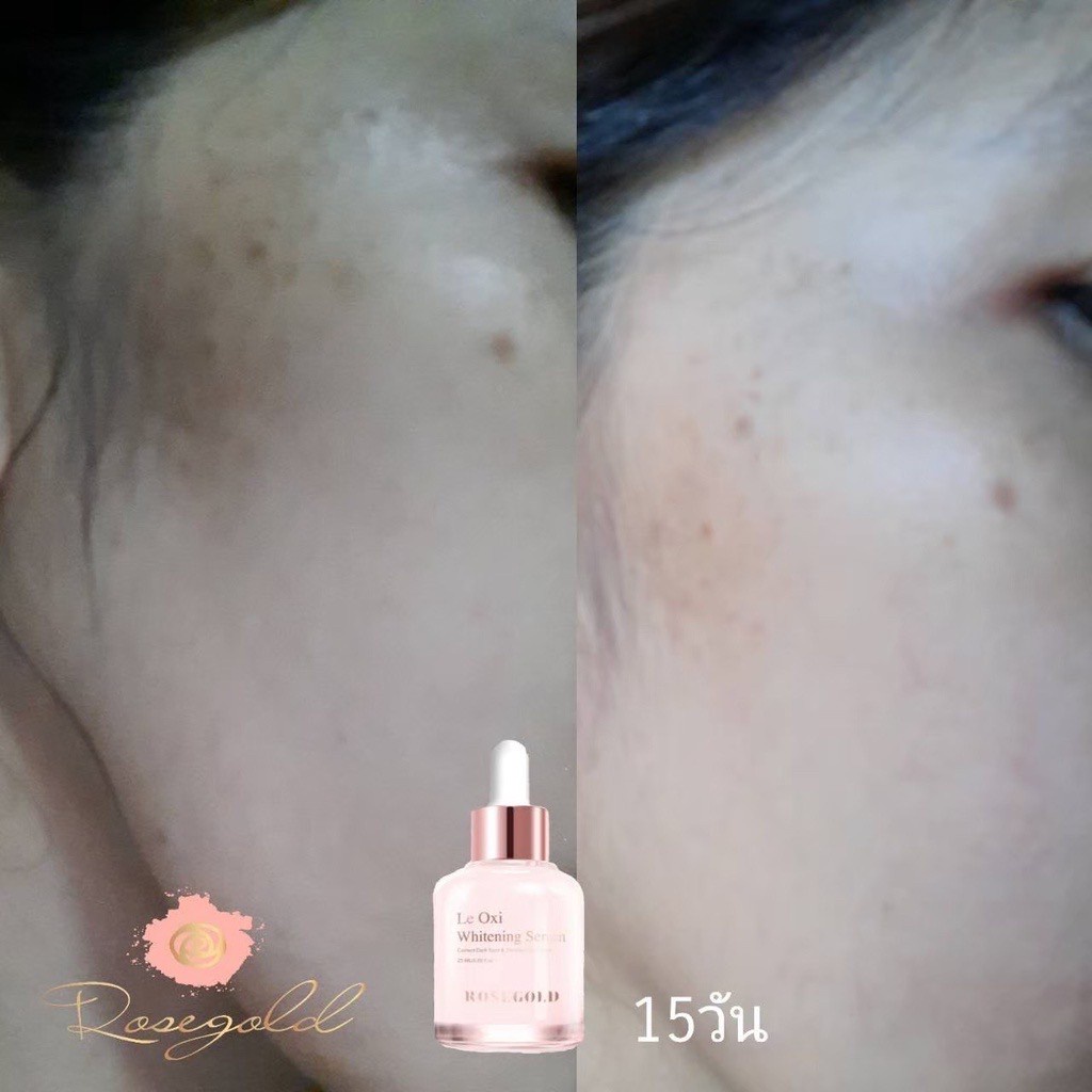 Rosegold เซรั่ม โรสโกลด์ LE OXI SERUM เลอ อ็อกซี่ ไวท์เทนนิ่ง เซรั่ม ช่วย ฝ้า กระ หน้ากระจ่างใส ...