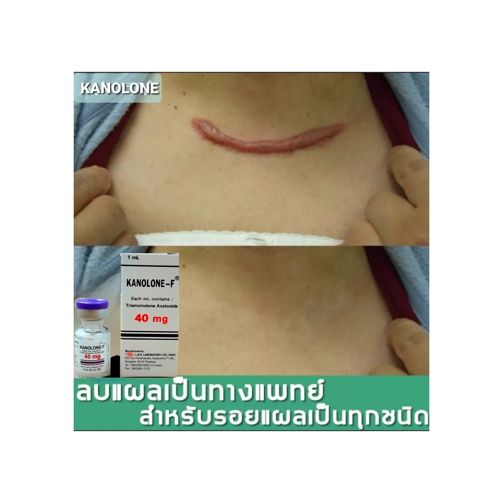 kanolone ราคาพิเศษ | ซื้อออนไลน์ที่ Shopee ส่งฟรี*ทั่วไทย!