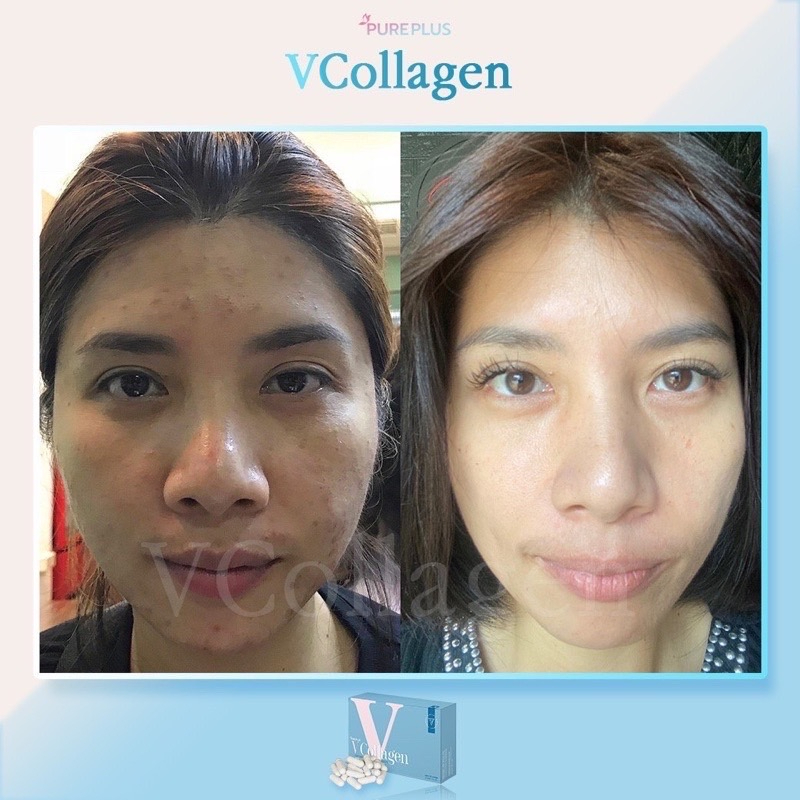 ส่งฟรีPureplus V Collagen ลดริ้วรอย ยกกระชับ ซ่อมแซมผิว สร้างคอลลาเจน ผิวกระจ่างใส ต้านอนุมูล ...