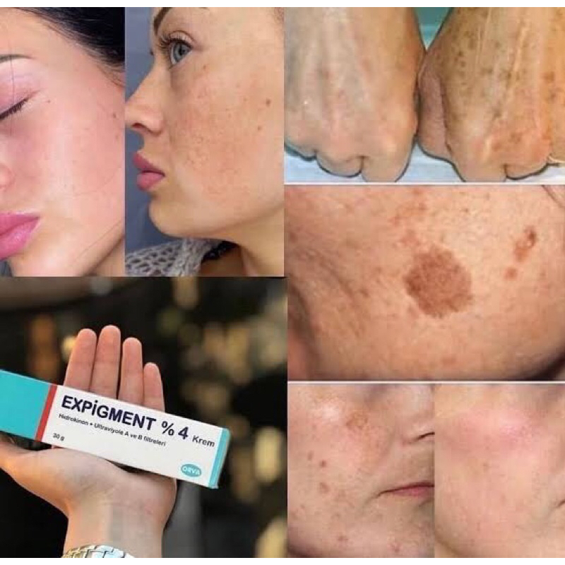 expigment ถูกที่สุด พร้อมโปรโมชั่น ก.ค. 2025 | BigGoเช็คราคาง่ายๆ